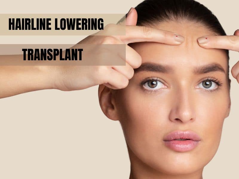 Hairline Lowering Surgery FAQs | Sieber Plastic Surgery